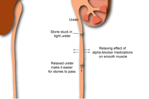 Passing a Stone - Kidney Stone Collaborative