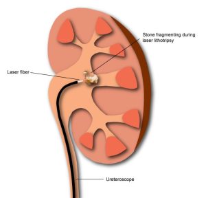 Kidney Stone Surgery: Treatment Options Explained